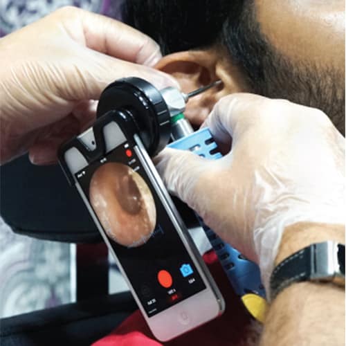 Microsuction - Ear Wax Removal Method - Hear4u